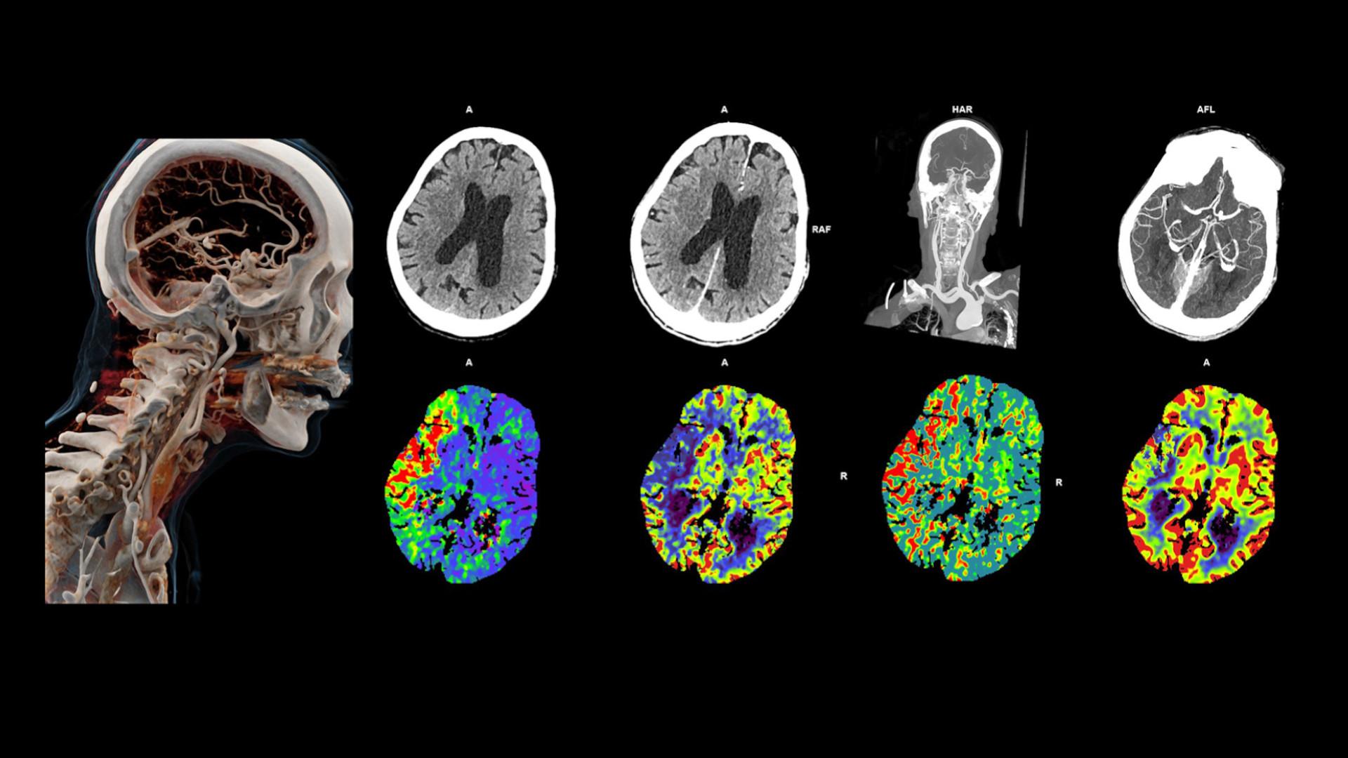 Neurology - Siemens Healthineers
