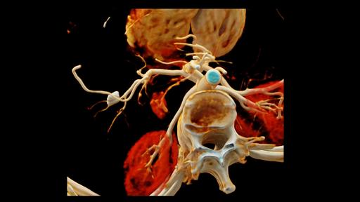 Multiple gastrinomas - Siemens Healthineers USA