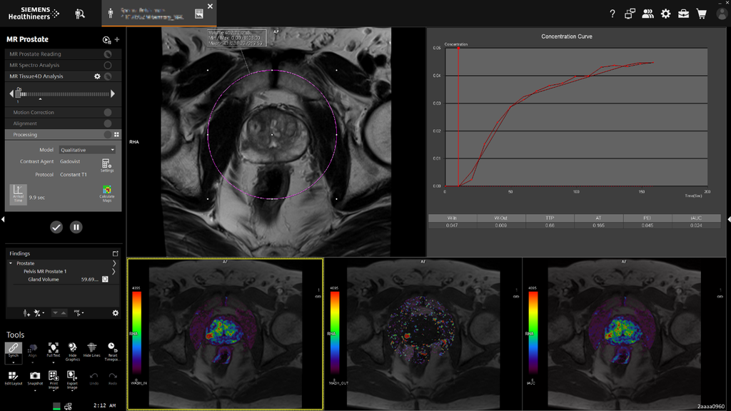 MR Prostate – AI-based segmentation and classification