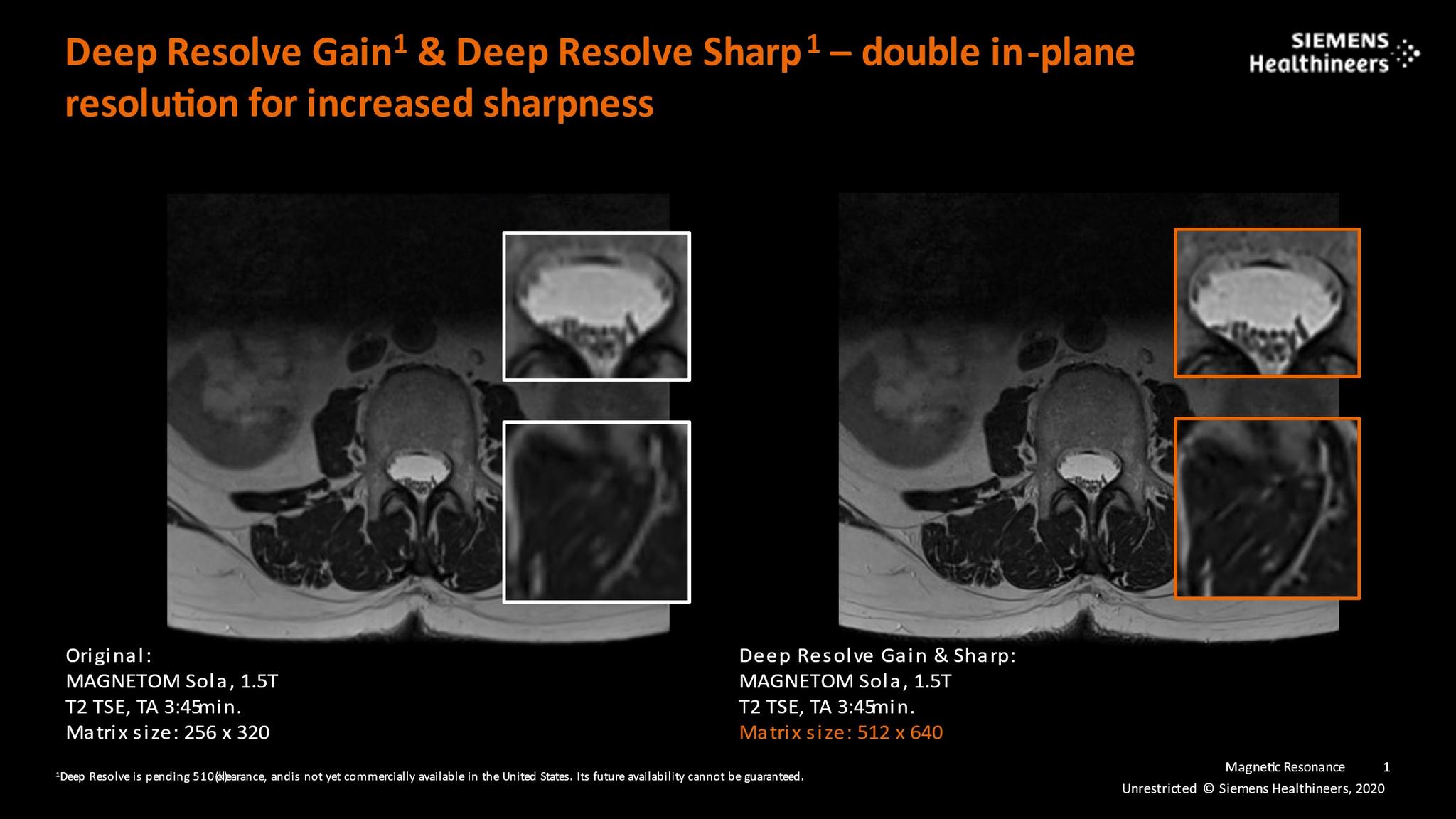 Deep Resolve in MRI