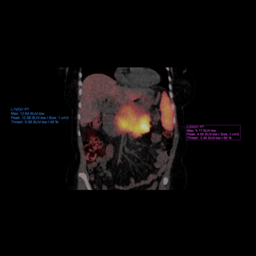 Symbia Intevo Bold - Siemens Healthineers Latinoamérica