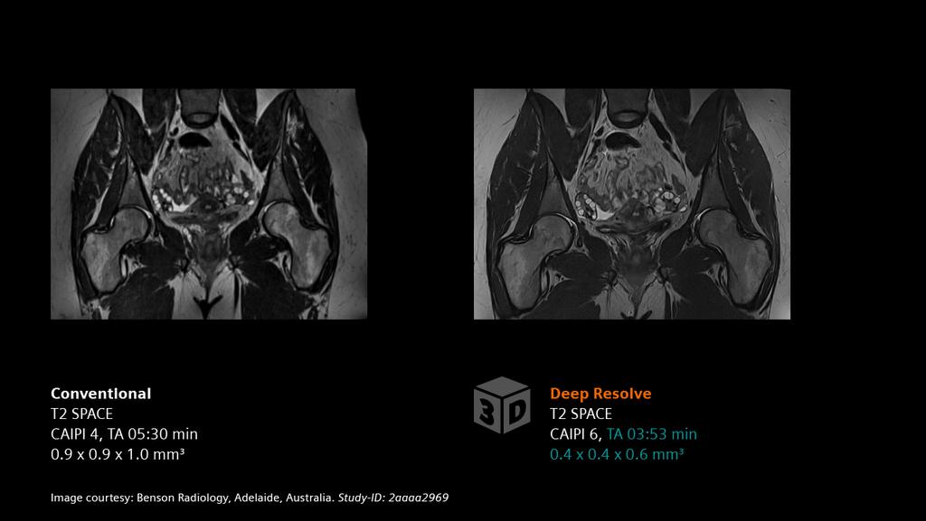 Deep Resolve - Siemens Healthineers
