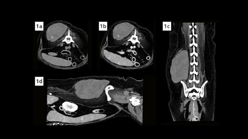 A Massive Paraspinal Dermal Hemangiosarcoma – Palliative or Surgical ...