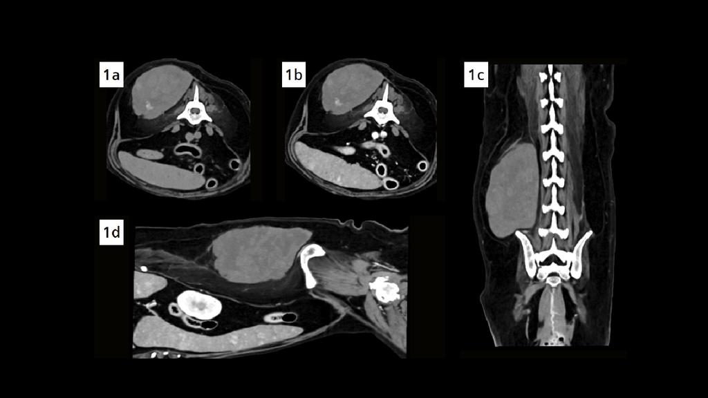 A massive paraspinal dermal hemangiosarcoma – palliative or surgical ...