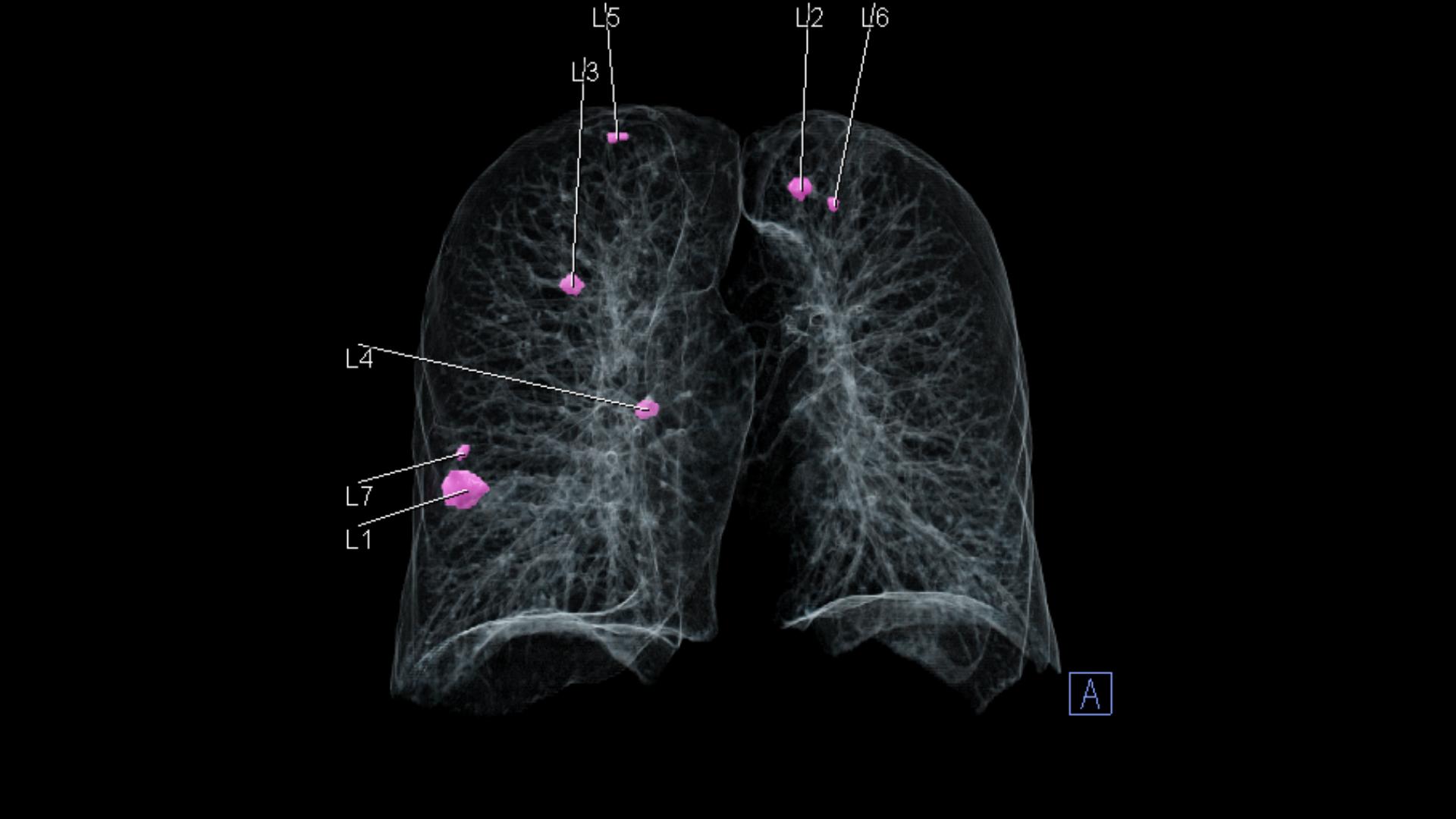 Diagnosis And Treatment Of Lung Cancer - Siemens Healthineers