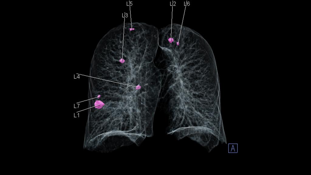 Diagnosis And Treatment Of Lung Cancer - Siemens Healthineers