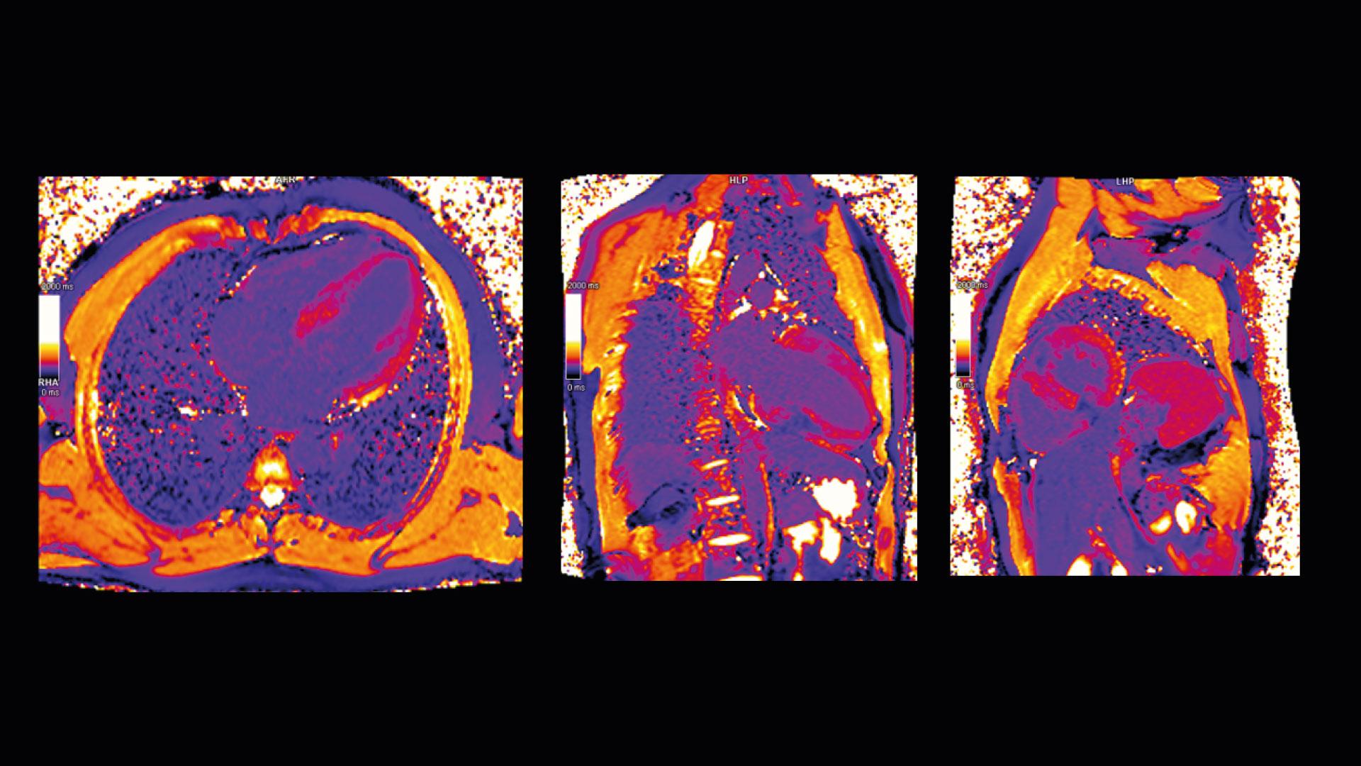 Fibrosis miocárdica: CRM sin electrodos de ECG - Siemens Healthineers ...