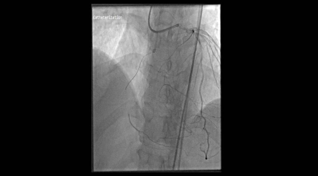 Multimodality Imaging in the Cath Lab for Guidance During CTO Treatment