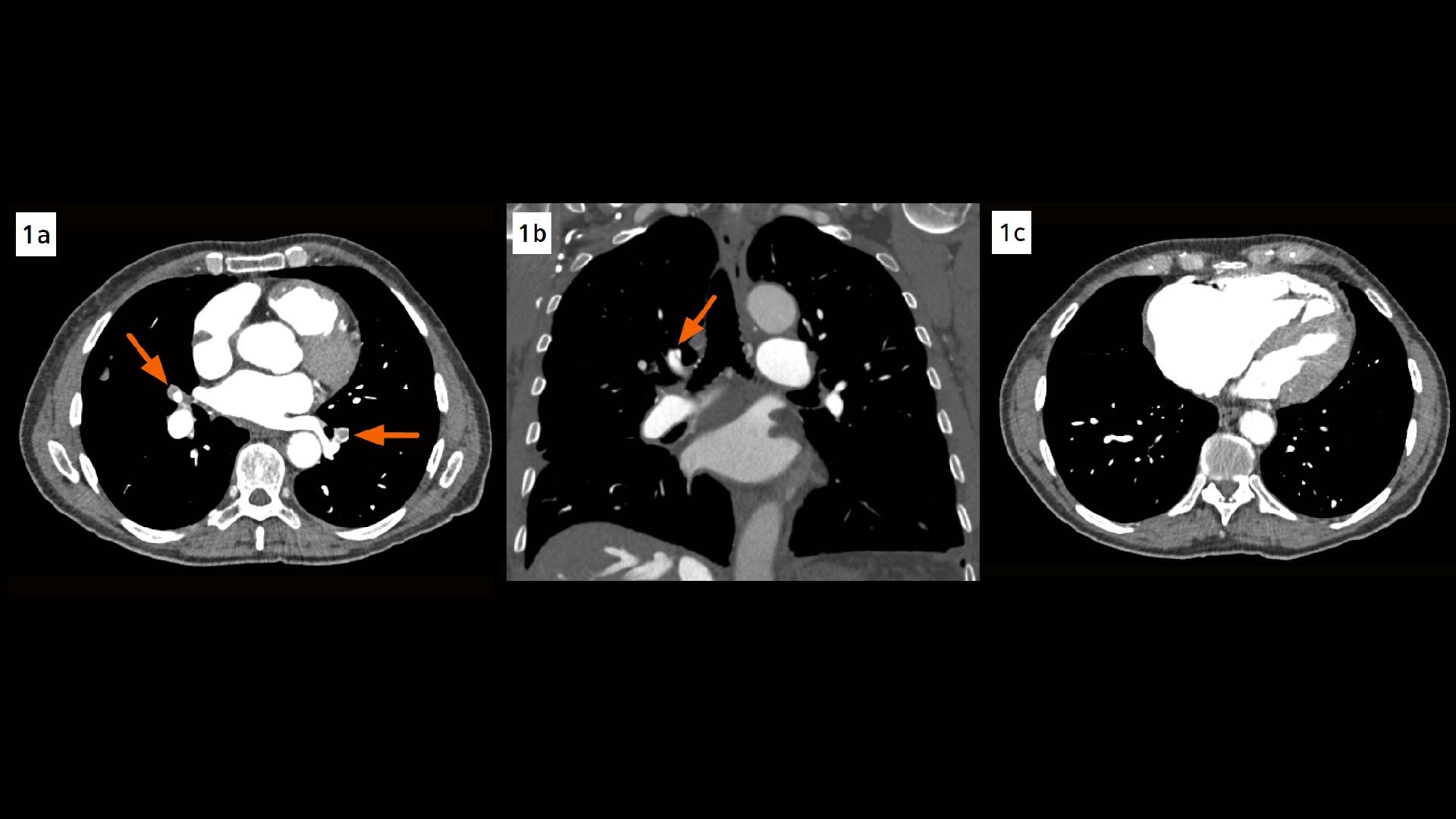Chronic thromboembolic pulmonary hypertension diagnosed after COVID-19 ...