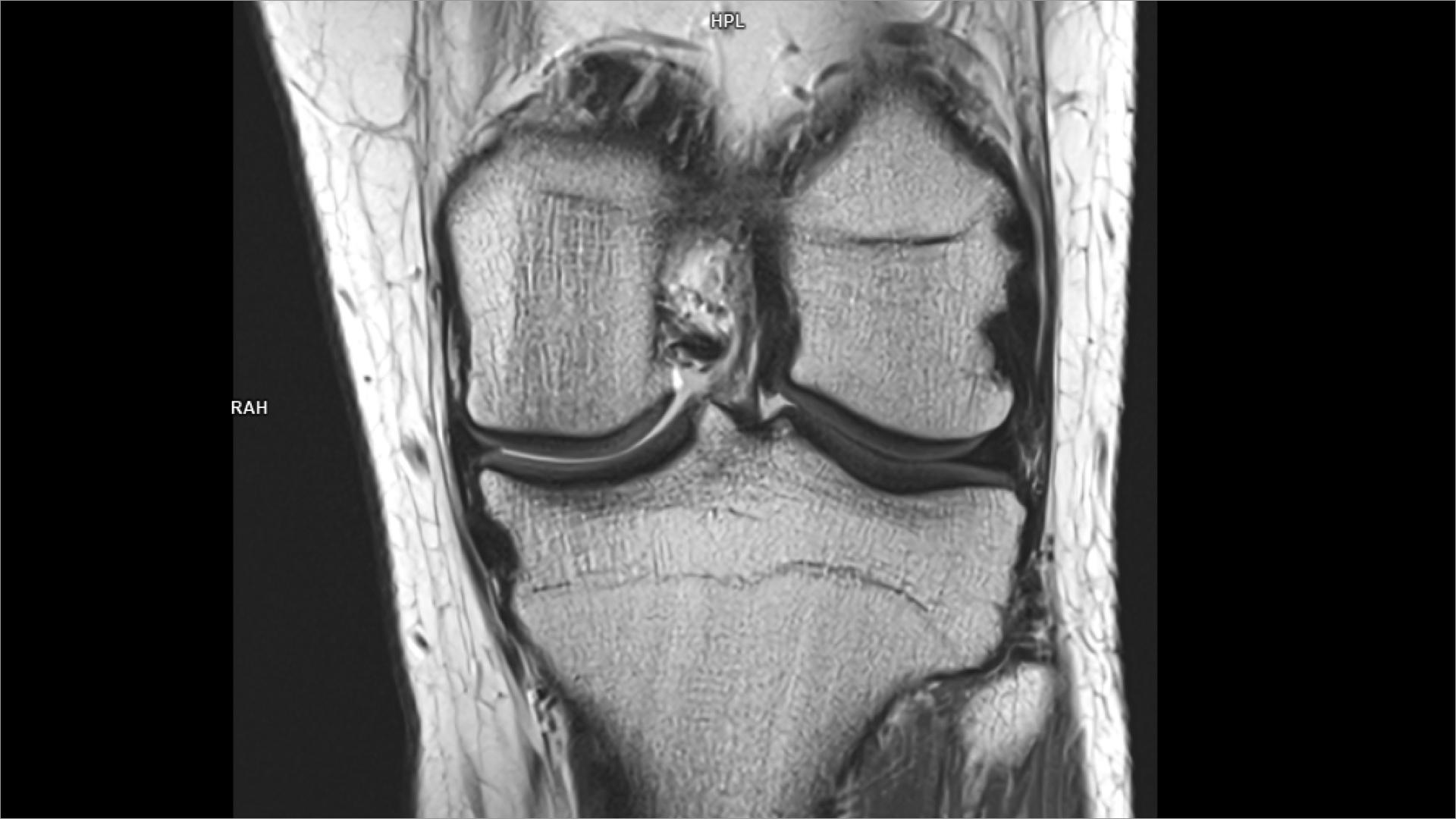 Coronal PD tse DR Sharp-MAGNETOM Vida - Siemens Healthineers USA