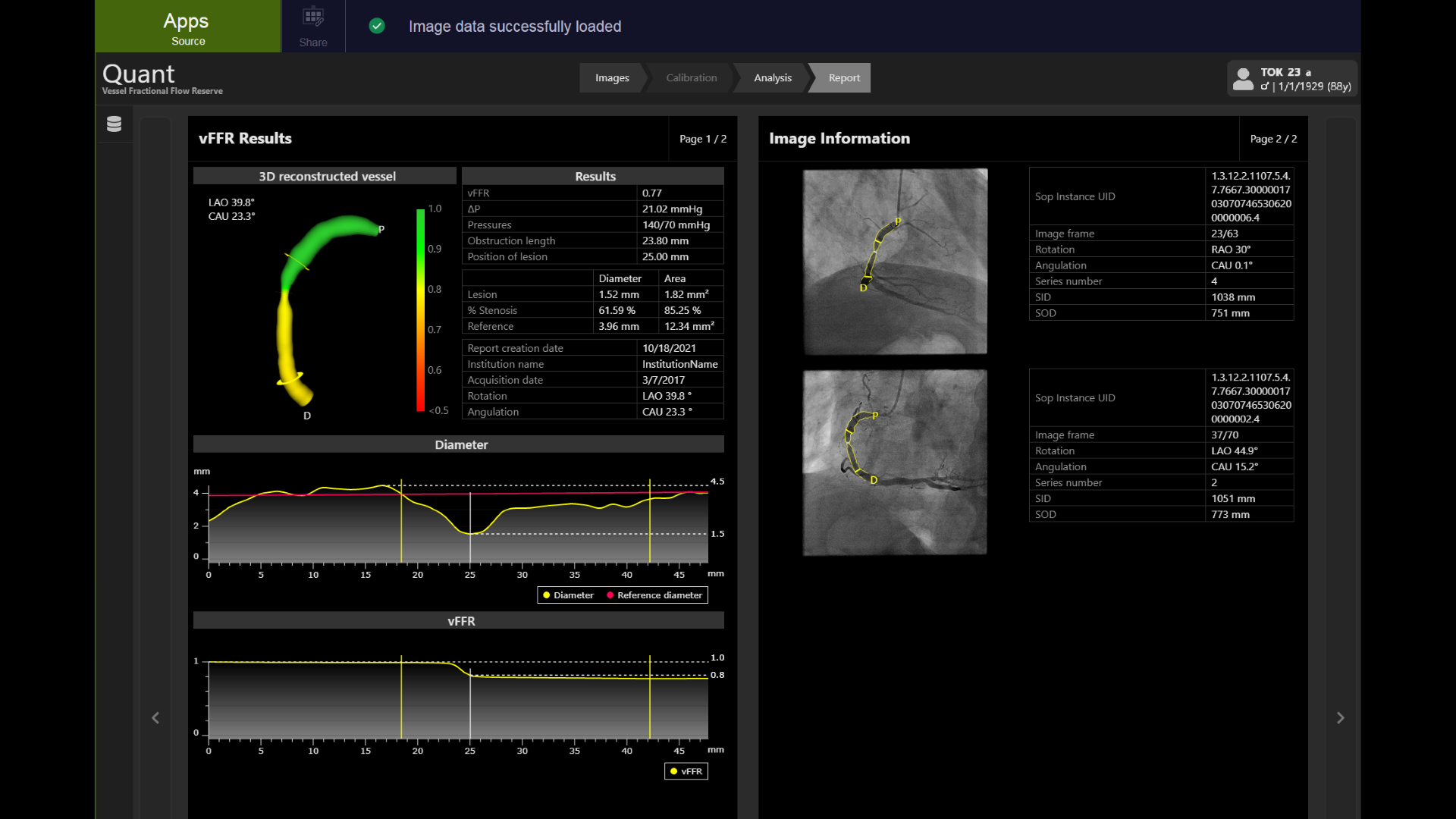 vFFR - angio-derived FFR measurements - Siemens Healthineers - Siemens ...