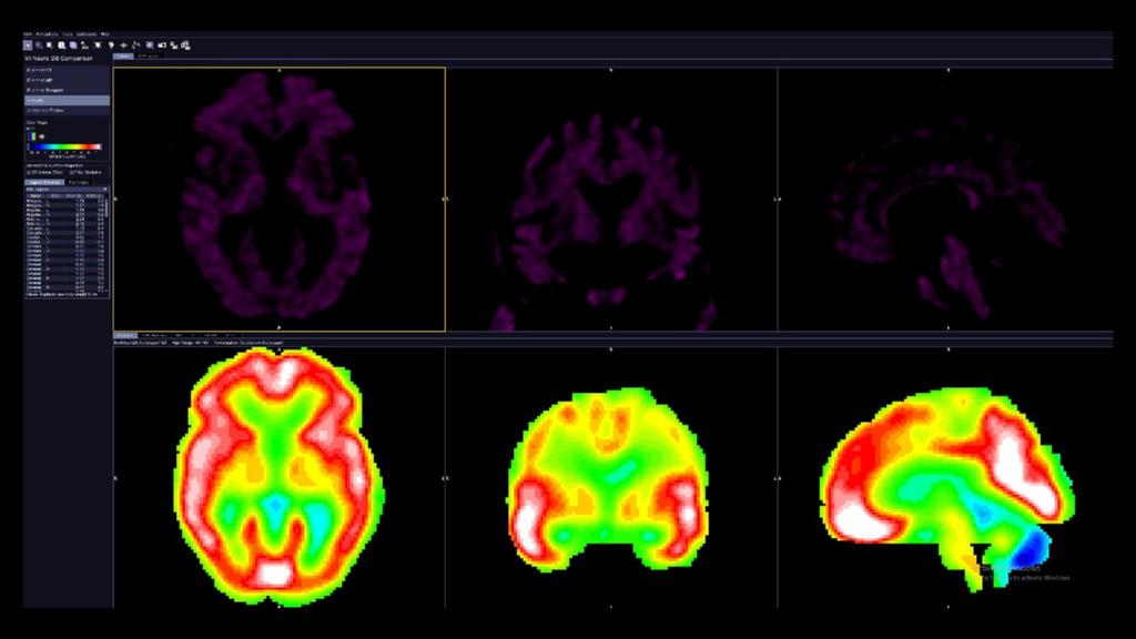 Beta-amyloid PET/CT imaging in the assessment of memory loss and dementia
