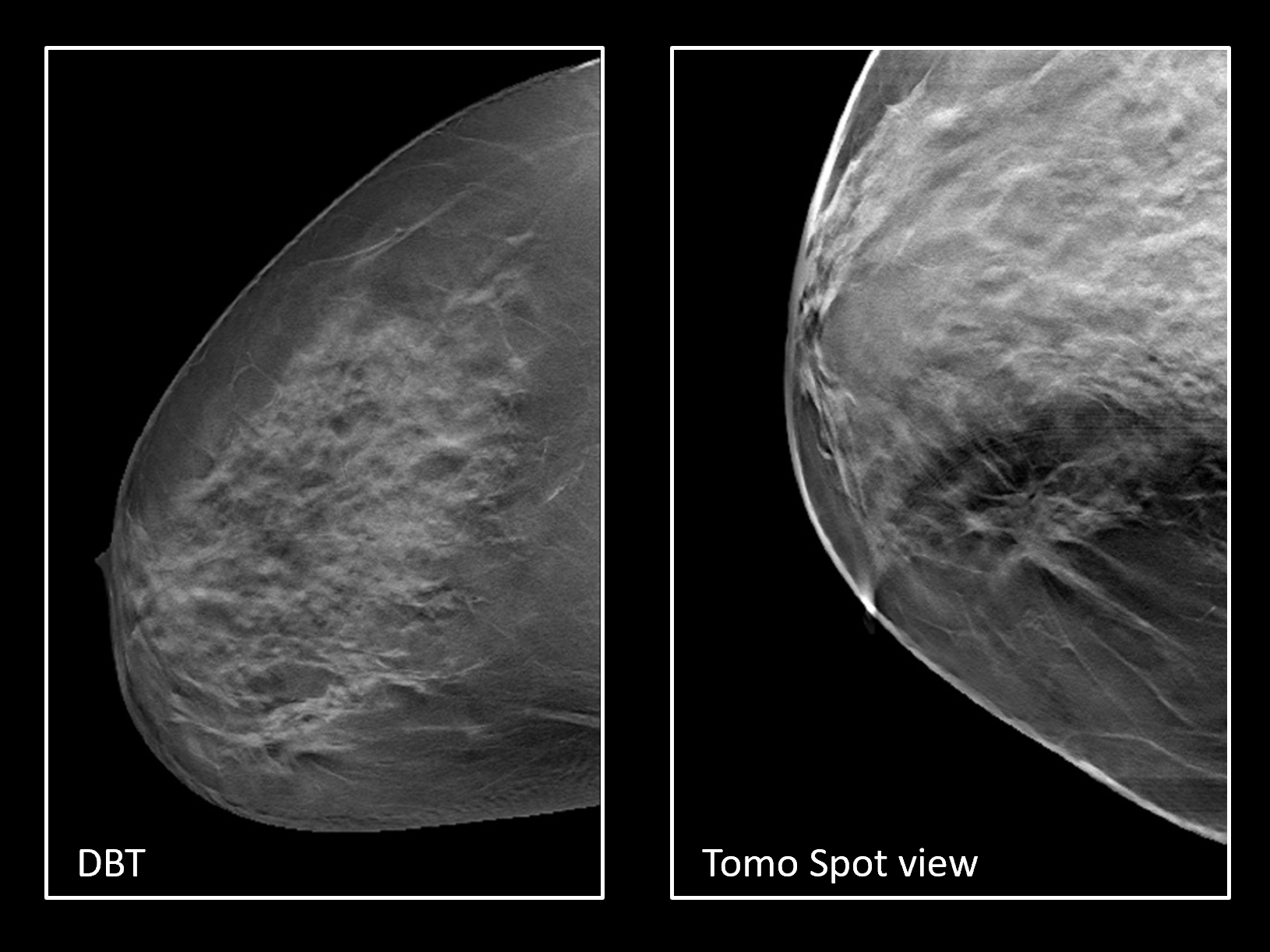 MAMMOMAT Revelation - Siemens Healthineers USA