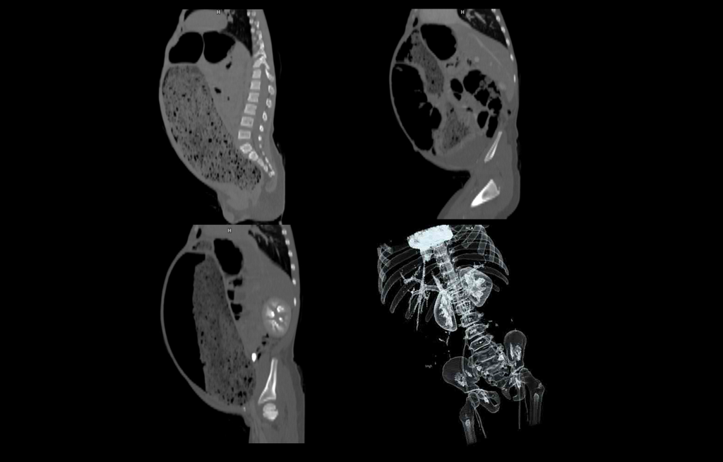 Hirschsprung’s Disease (HD) - Congenital Megacolon Child Imaging with ...