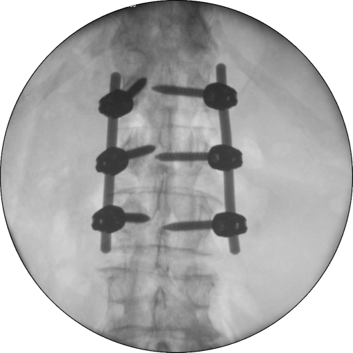 Mobile C-arm machine - Cios Select - Siemens Healthineers USA