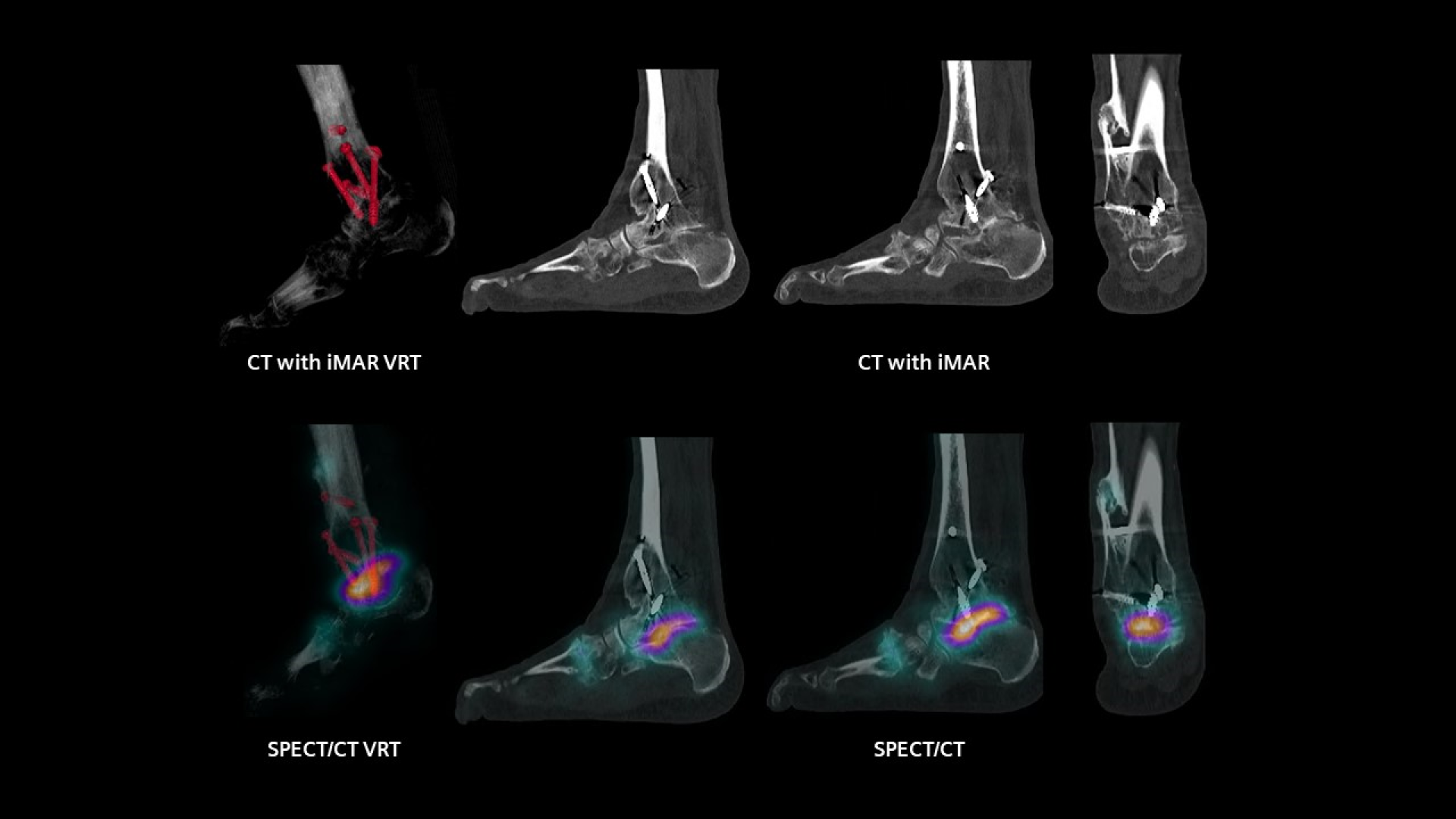 SPECT/CT in musculoskeletal medicine - Siemens Healthineers USA
