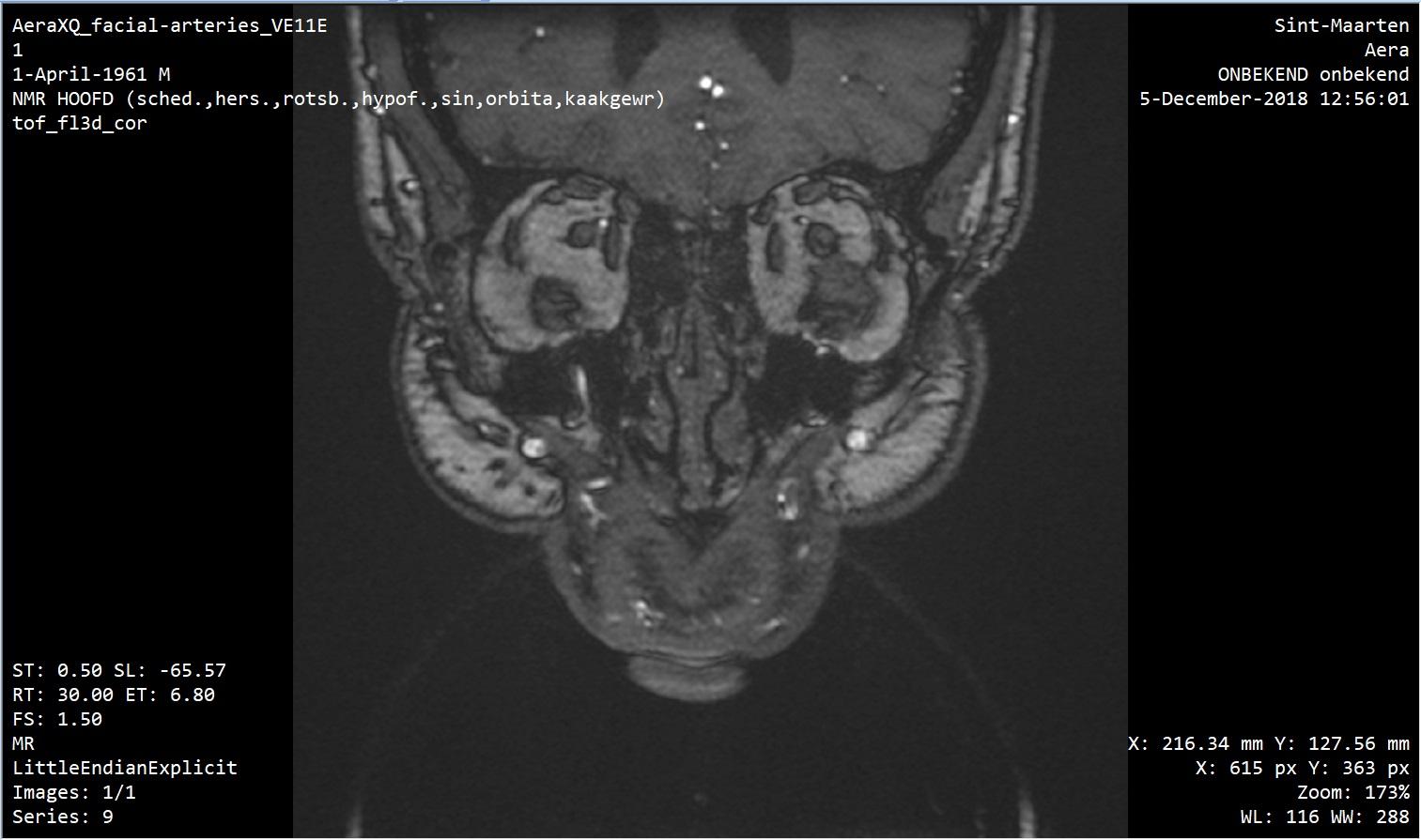 Infrared Thermally Enhanced 3D TOF MOTSA MR Angiography for Visualizing ...