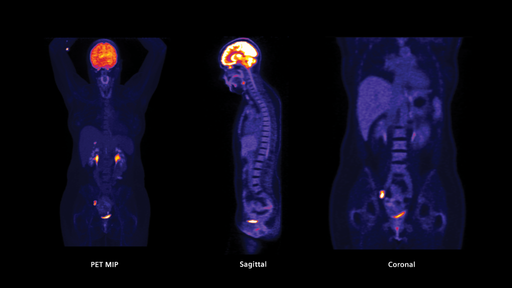 Biograph Vision PET/CT Clinical Image Gallery - Siemens Healthineers