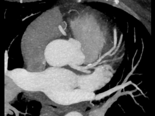 How Users are Exploring Untapped Potential in Dual Source CT - Siemens ...