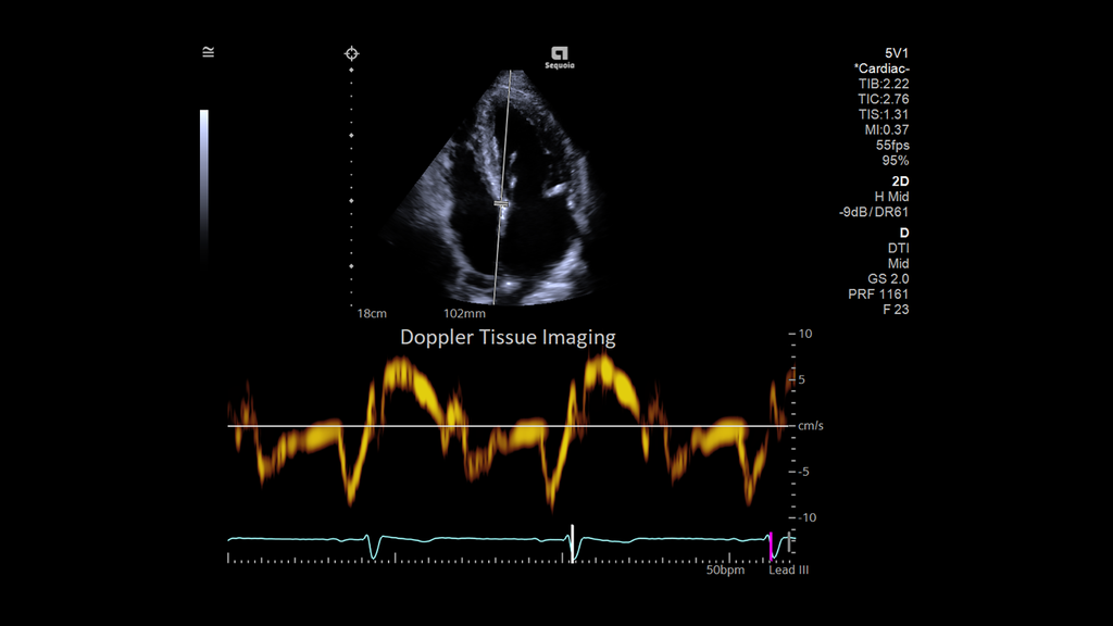 ACUSON Sequoia Ultrasound System - Siemens Healthineers
