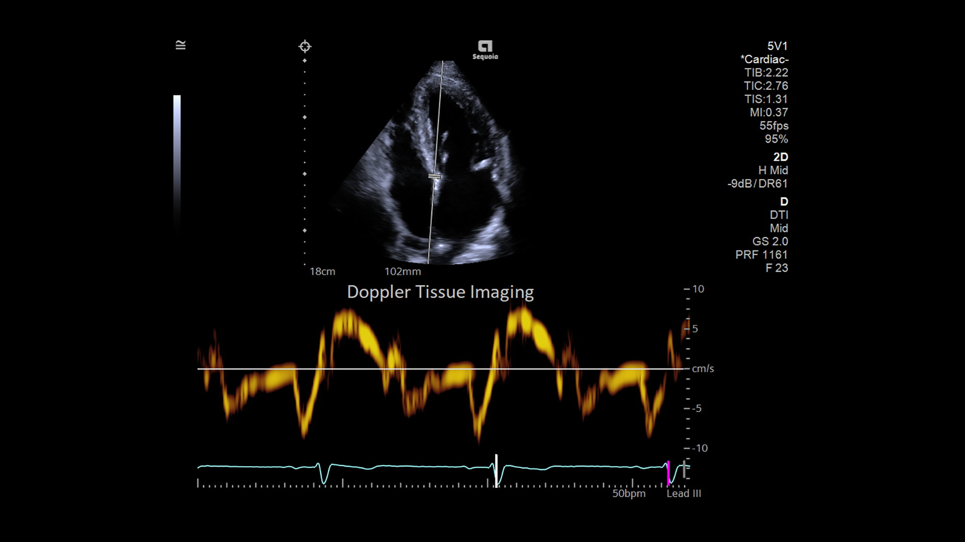ACUSON Sequoia Ultrasound System - Siemens Healthineers