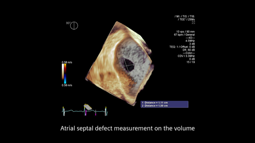 Cardiovascular Ultrasound | ACUSON SC2000 Ultrasound System - Siemens ...