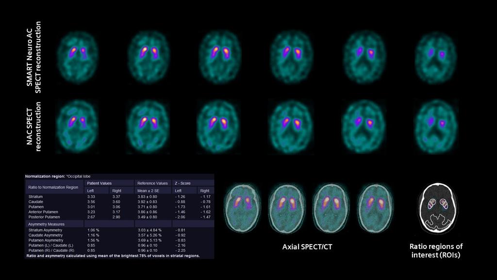 Symbia Pro.specta SPECT/CT - Siemens Healthineers