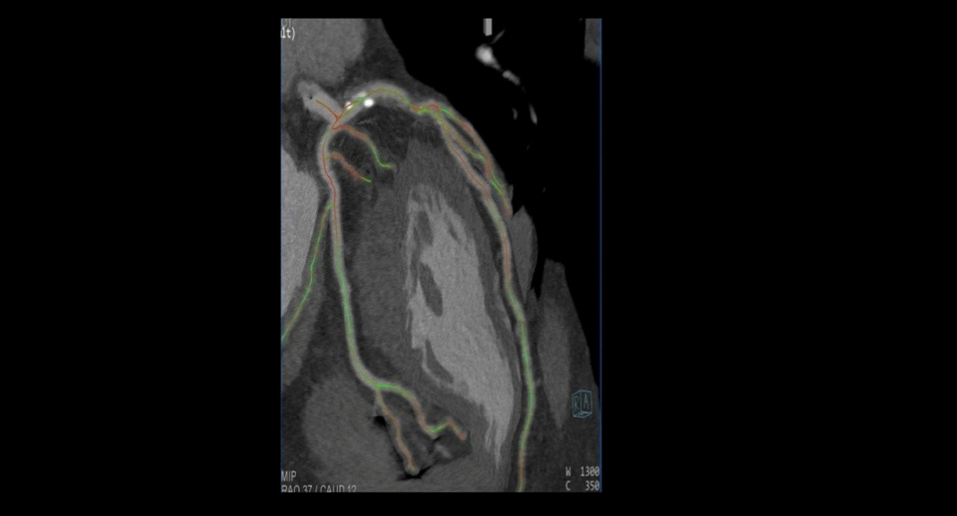 Multimodality Imaging in the Cath Lab for Guidance During CTO Treatment