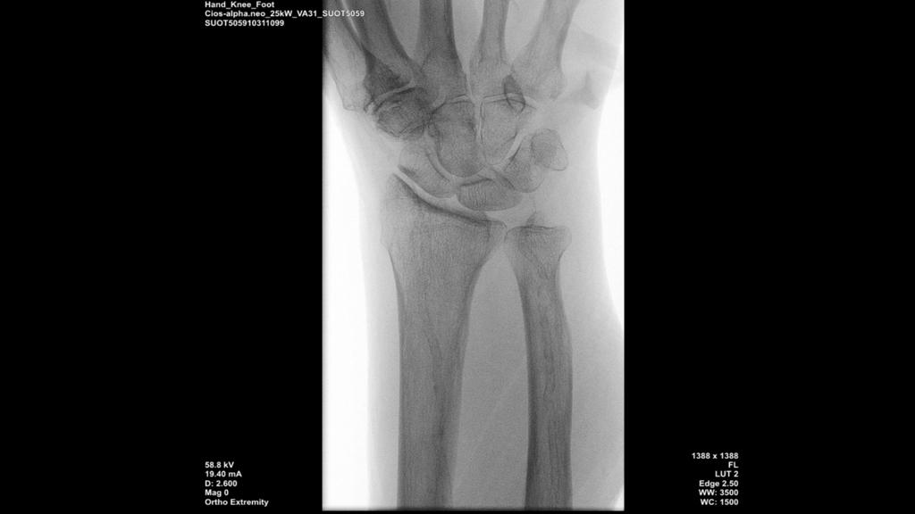 Cios Alpha.neo – Mobile C-arm machine