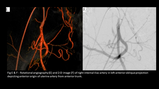 Three-Dimensional Rotational Angiography in Uterine Fibroid Embolization