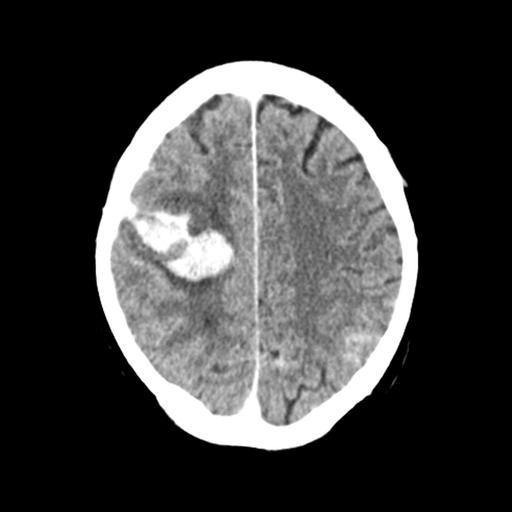 Advanced Stroke Management & Patient Care - Siemens Healthineers USA