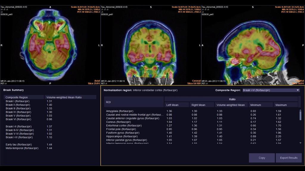 Beta-amyloid PET/CT imaging for Alzheimer's disease - Siemens ...