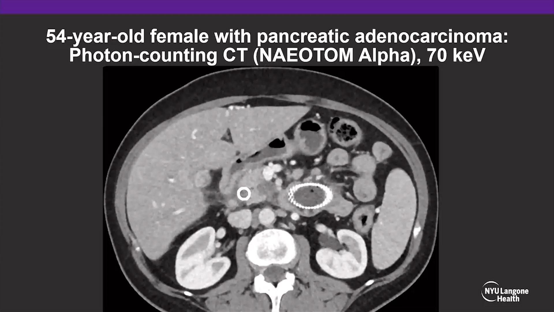 Abdominal Photon Counting Ct Cases Siemens Healthineers