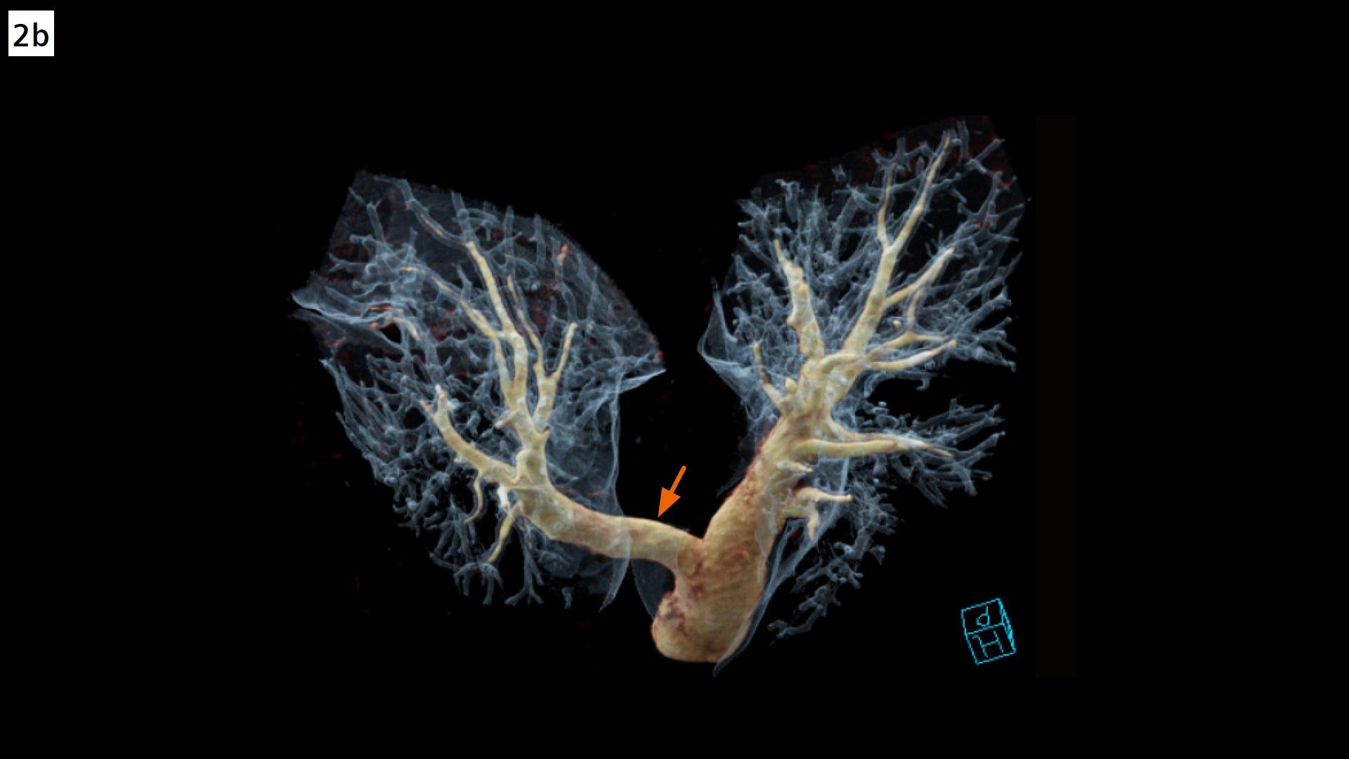 Scimitar syndrome - Siemens Healthineers