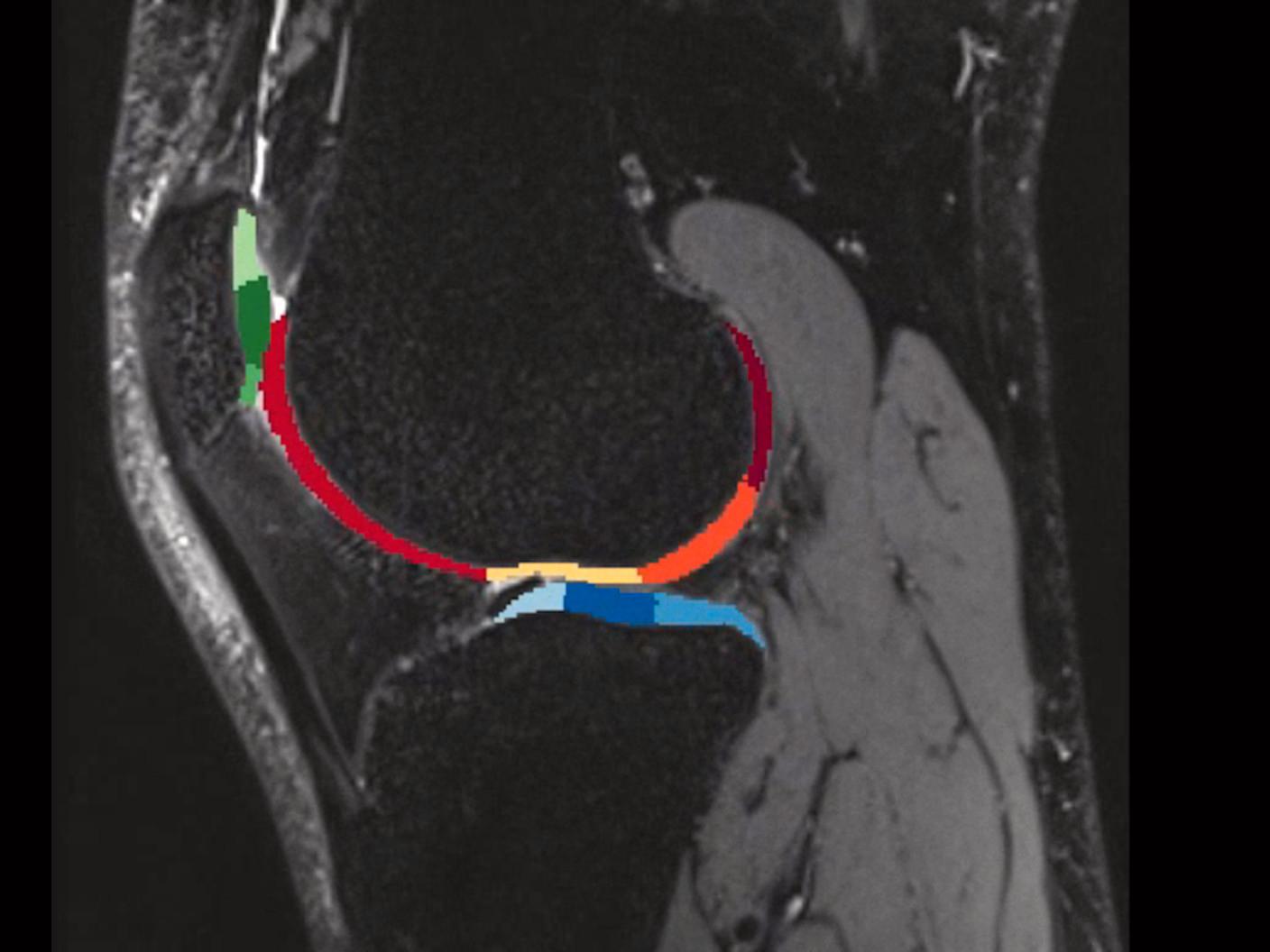 High-res PD-SPACE for segmentation with Chondral Quant