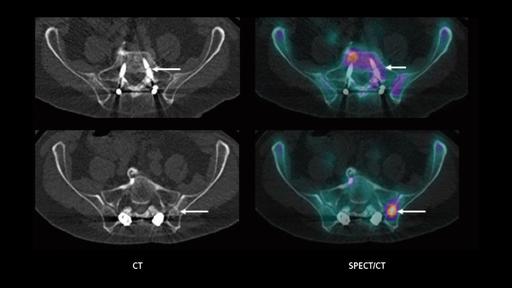 SPECT/CT imaging in the evaluation of pain following spinal fusion ...