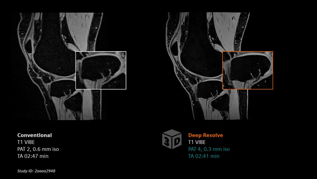 Deep Resolve - Siemens Healthineers