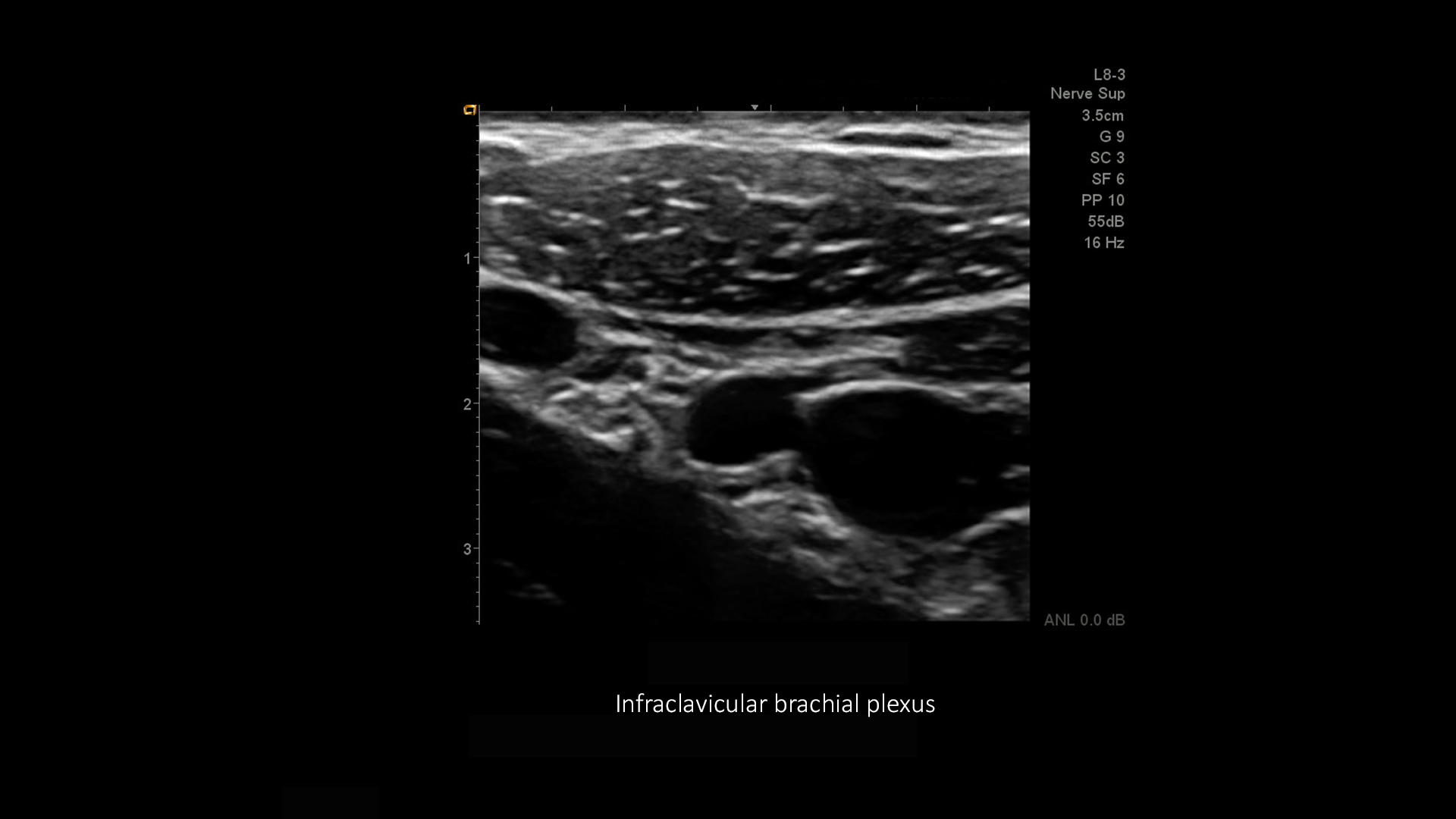 Wireless Ultrasound System | ACUSON Freestyle - Siemens Healthineers USA