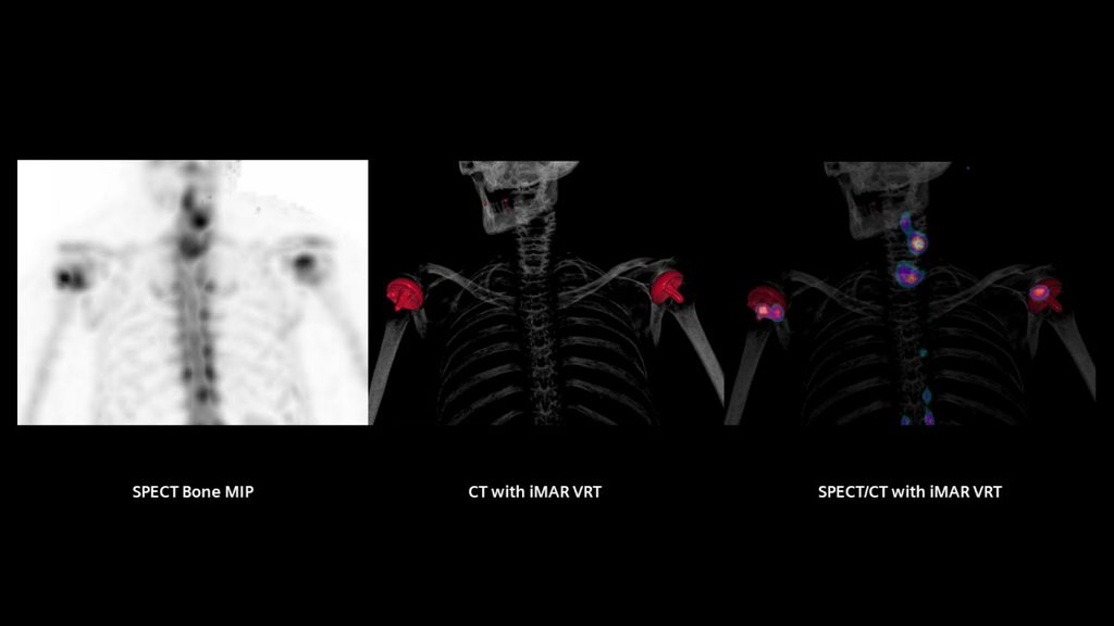 SPECT/CT in musculoskeletal medicine - Siemens Healthineers