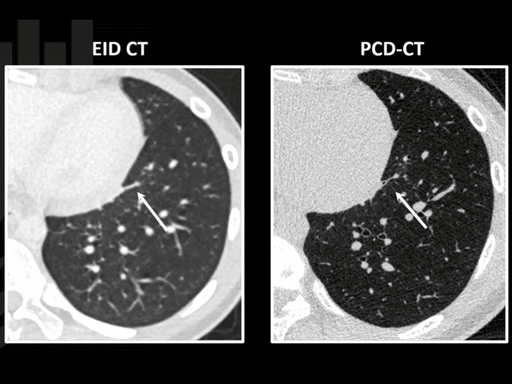 NAEOTOM Alpha.Prime - The first single-source photon-counting CT ...