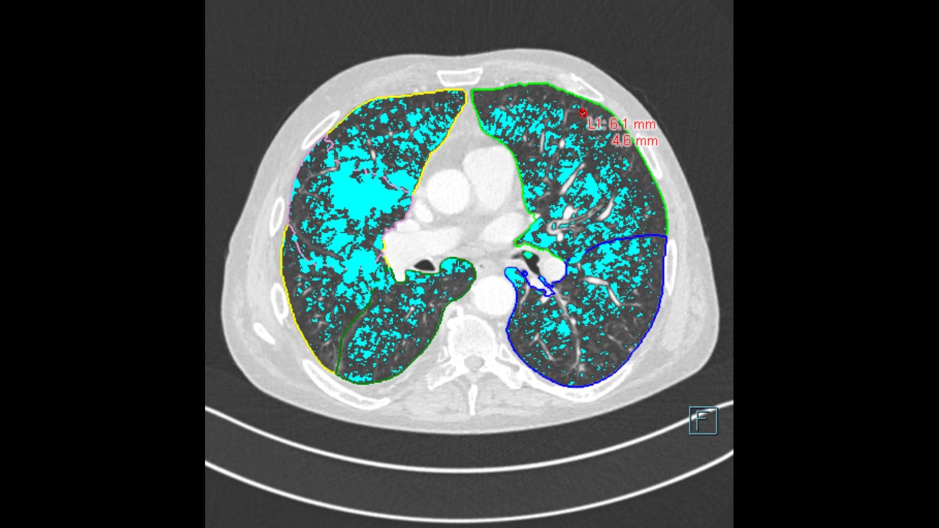AI-Rad Companion Chest CT - Siemens Healthineers Phillipines