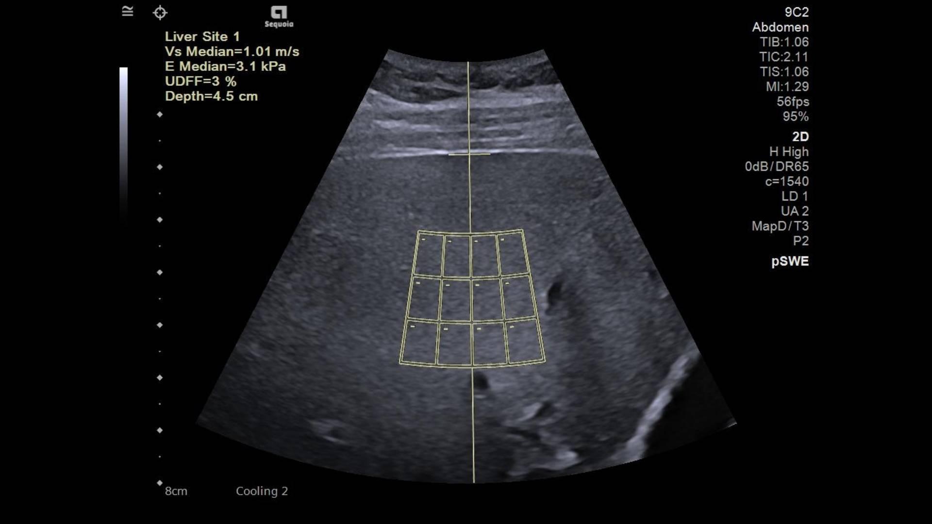 ACUSON Sequoia Ultrasound Machine for Pediatrics - Siemens Healthineers
