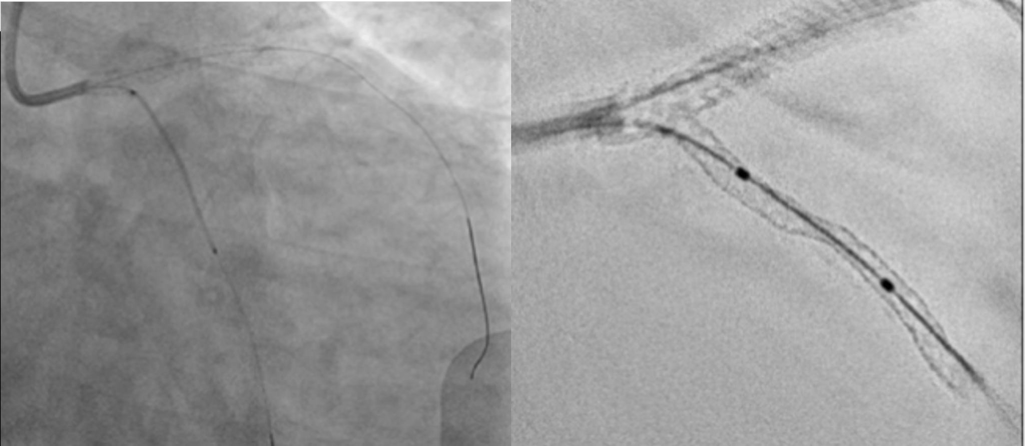 Enhanced stent visualization assists in improving the outcome of ...
