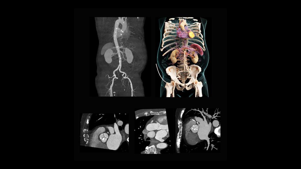 CT Cardiovascular imaging - Siemens Healthineers India