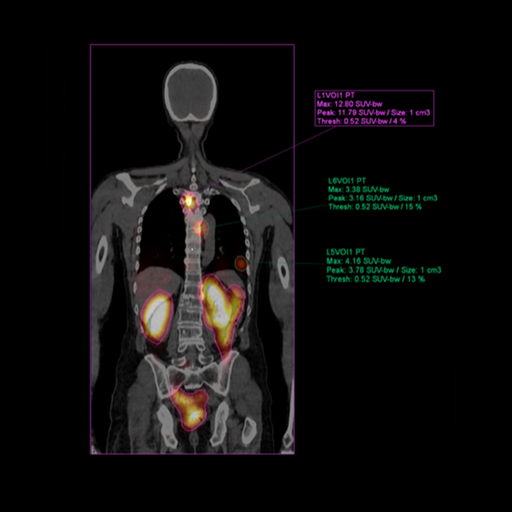 Symbia Intevo Bold eco - Siemens Healthineers