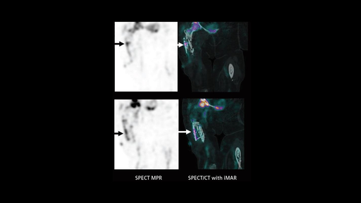 Localization Of Infection Site In Femoral Stabilization Pin - Siemens ...