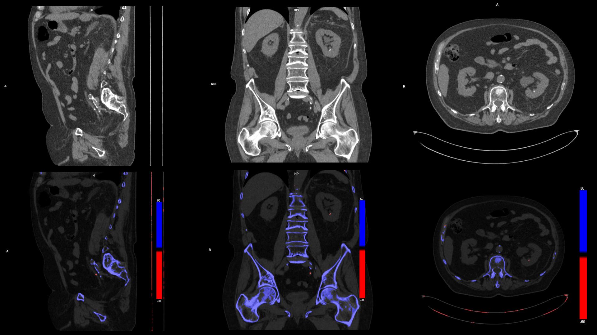 Dual Energy CT Spectral Imaging - Siemens Healthineers USA