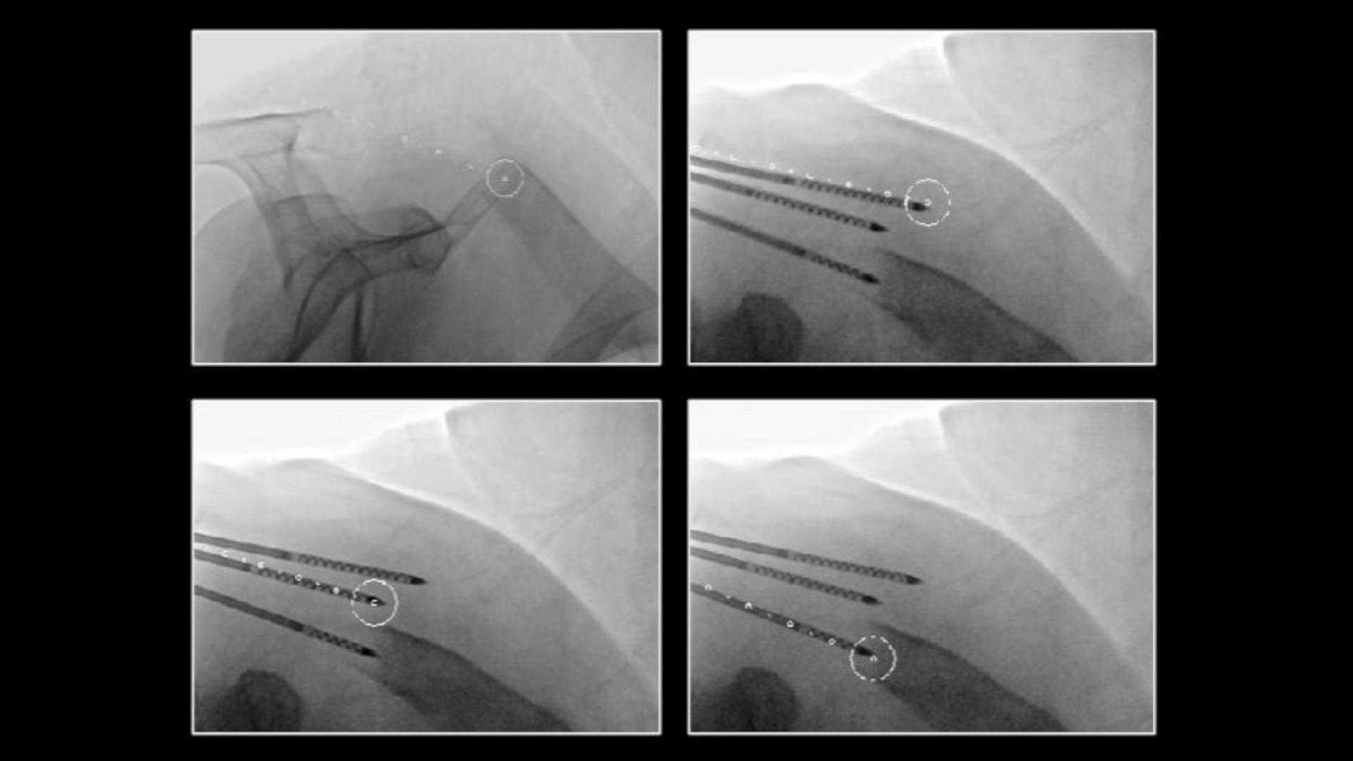 Interventional Oncology Procedures - Siemens Healthineers