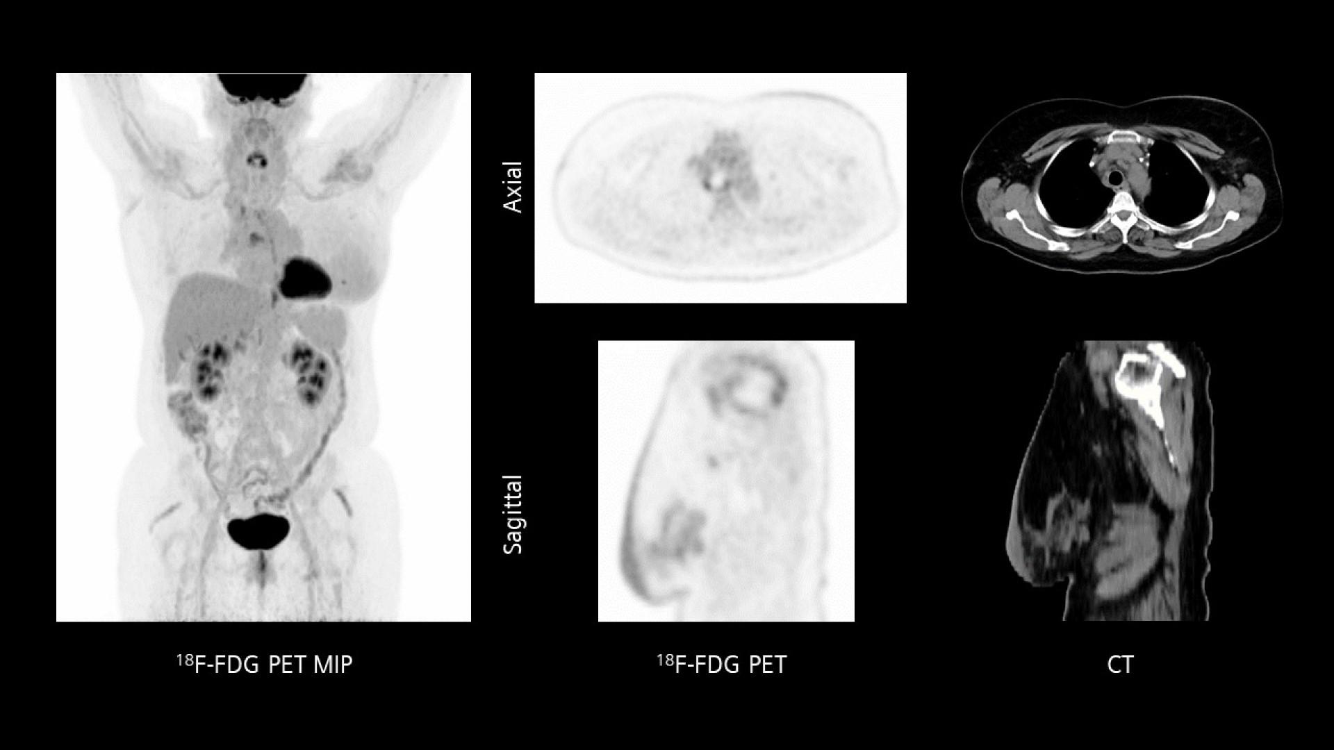 18F-FES PET/CT distinction of ER-positive lesions in a patient with ...