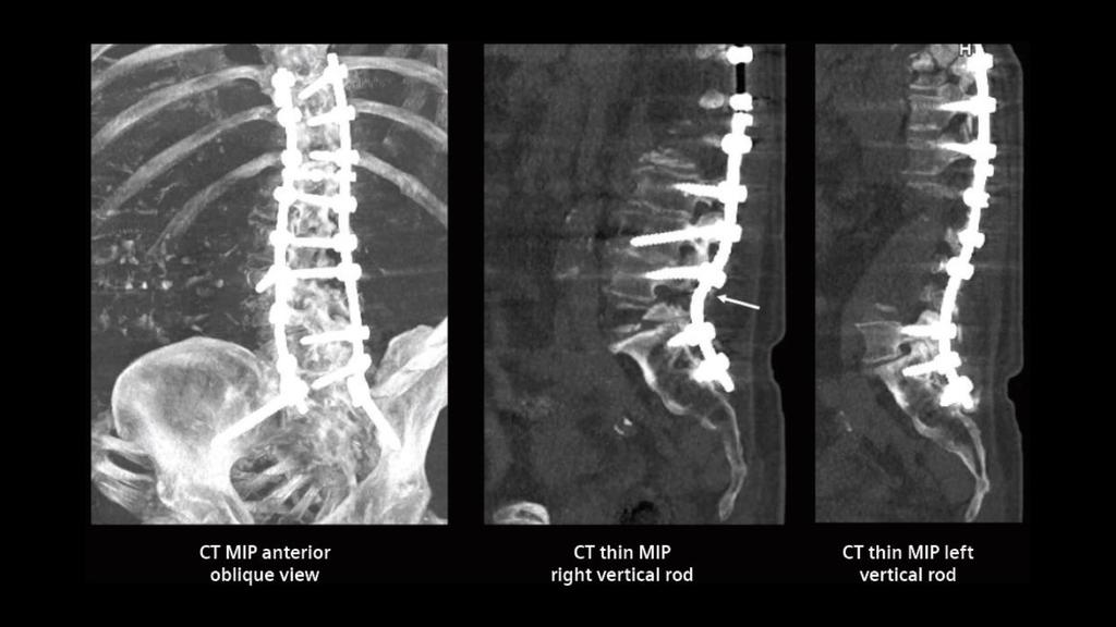 SPECT/CT imaging in the evaluation of pain following spinal fusion ...
